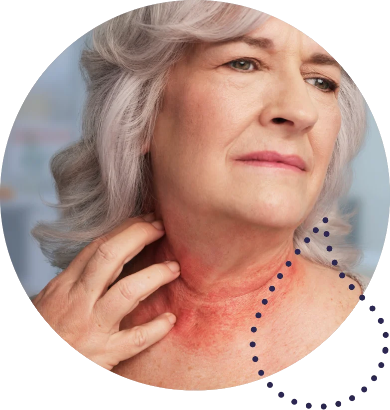 Trial Overview | Atopic Dermatitis | OPZELURA® (ruxolitinib) HCP