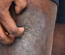 View & Download Savings Card | Atopic Dermatitis | OPZELURA ...